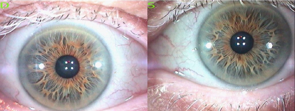 The Collarette - Clinical Neuro-Optic Reseach Institute