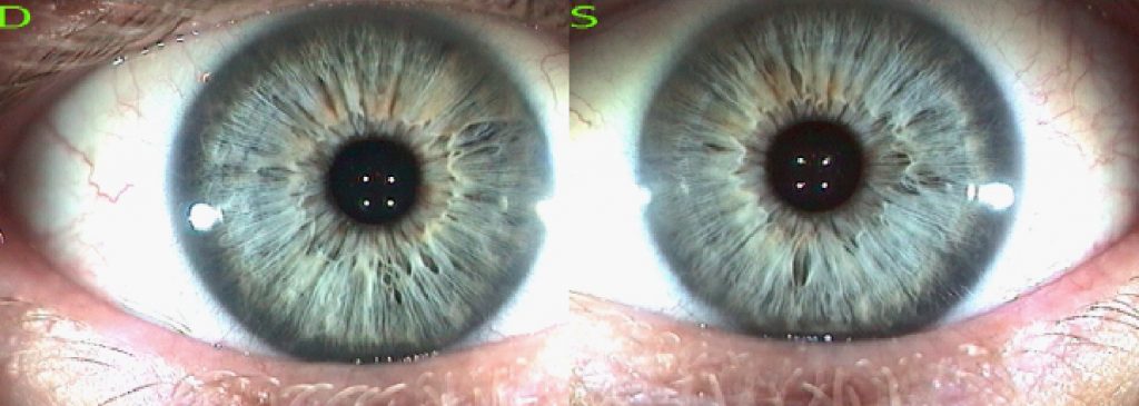 The Collarette - Clinical Neuro-Optic Reseach Institute