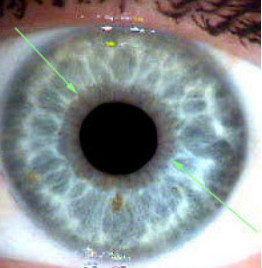 The Collarette - Clinical Neuro-Optic Reseach Institute