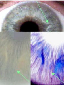 The Collarette - Clinical Neuro-Optic Reseach Institute