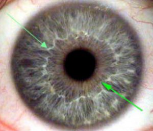 The Collarette - Clinical Neuro-Optic Reseach Initiative