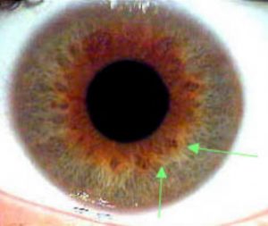 The Collarette - Clinical Neuro-Optic Reseach Institute