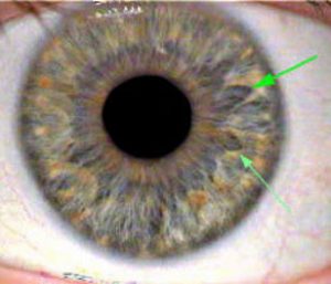 The Collarette - Clinical Neuro-Optic Reseach Institute